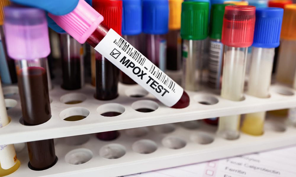 California Reports First Case of Mpox in the United States | | Post ...